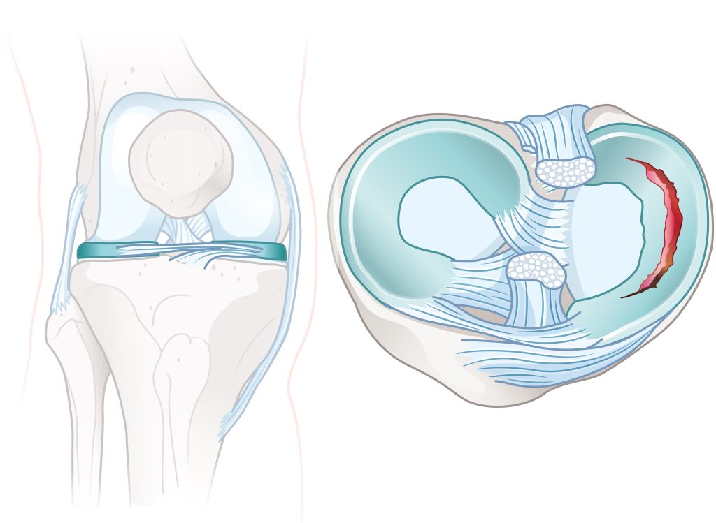 Why Does My Knee Click, Catch or Lock? | Newcastle
